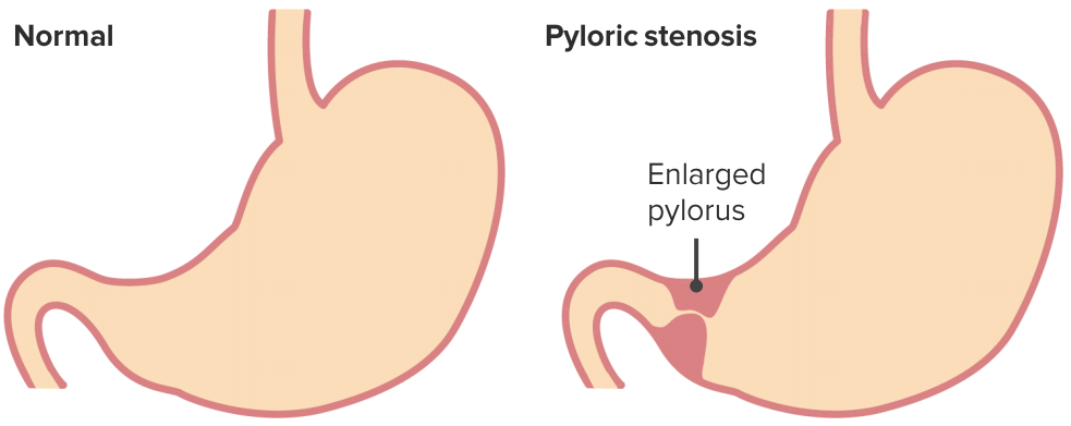 Pyloric stenosis - Critical Care Collaborative Pyloric stenosis - Critical Care Collaborative