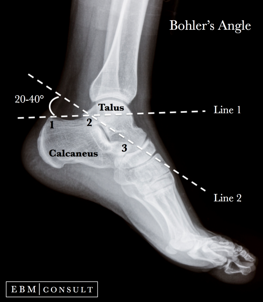 Foot injuries - Critical Care Collaborative Foot injuries - Critical Care Collaborative