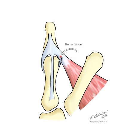 Hand and digit injuries - Critical Care Collaborative